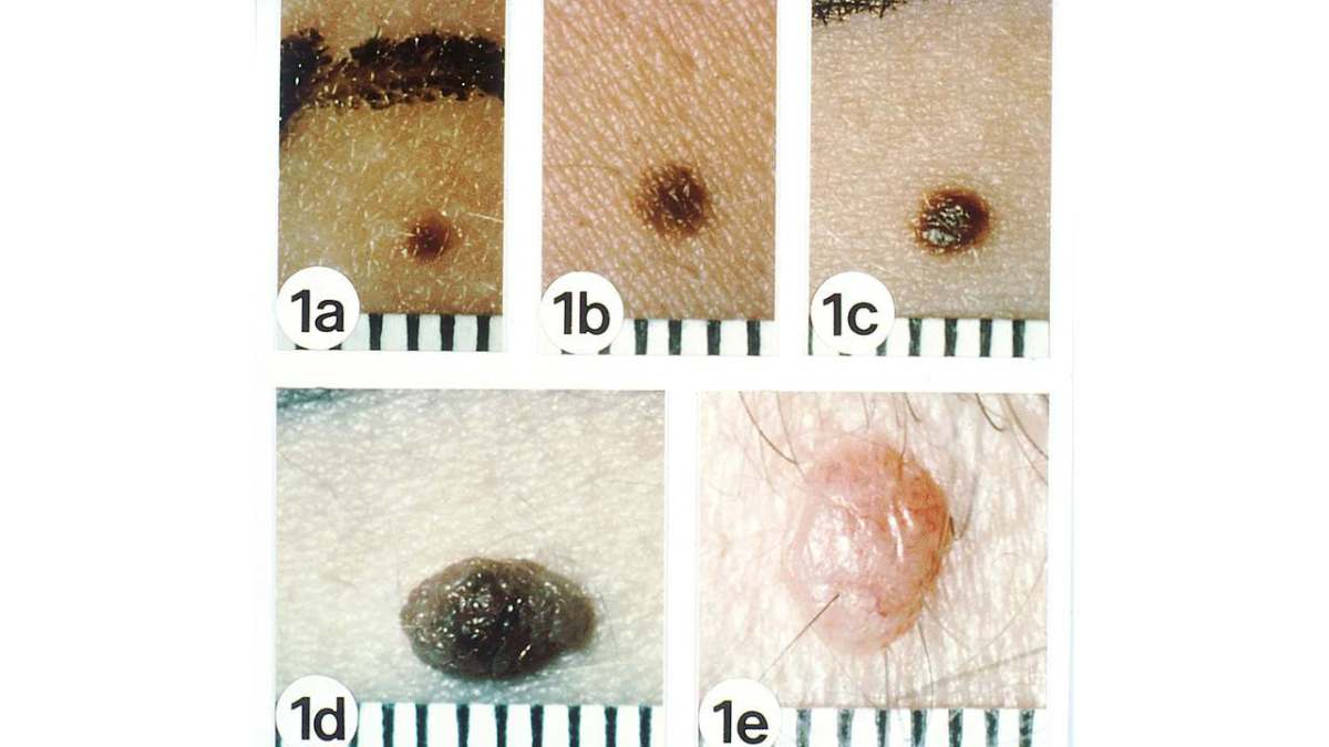 Black Mole Melanoma Skin Cancer black-mole-melanoma-skin-cancer